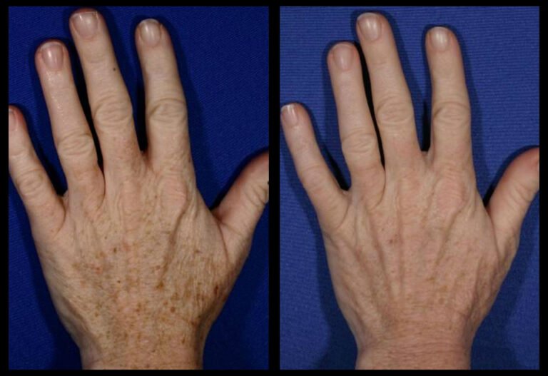 Restore Sun-Damaged Hands - Elite Body and Laser