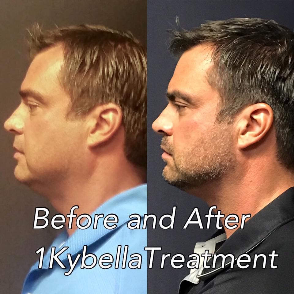 Kybella Injections | Sculpt Double Chin Away