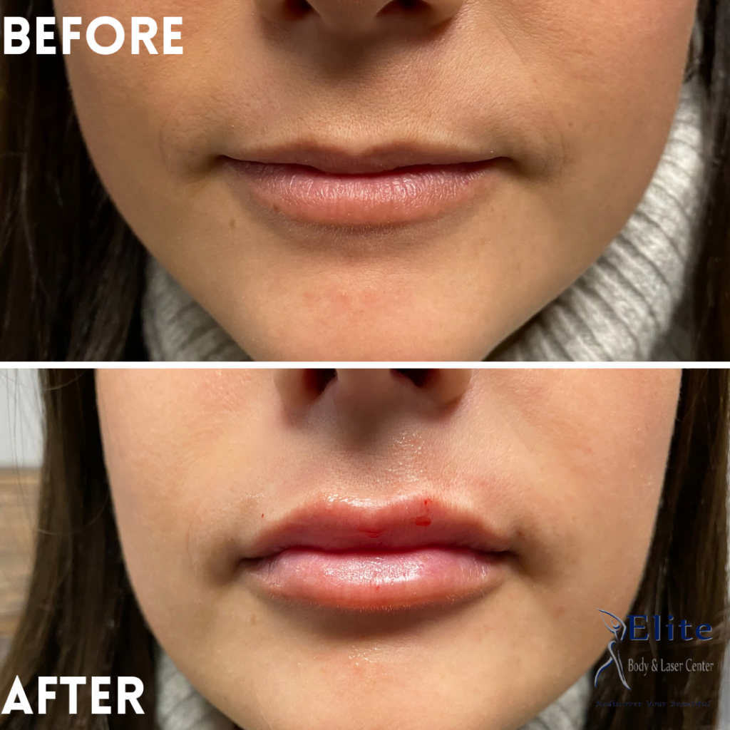 Restylane Kysse Lip Filler | What You Should Know