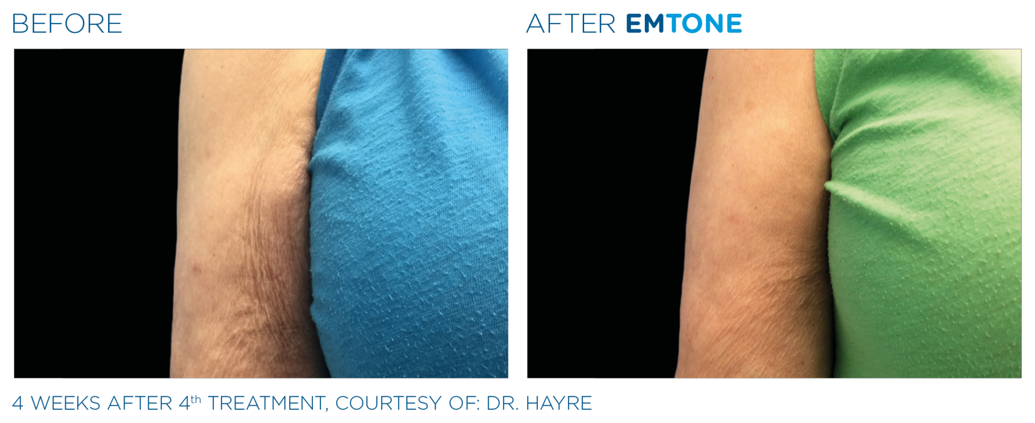 Emtone - Cellulite Treatment.- Elite Body and Laser