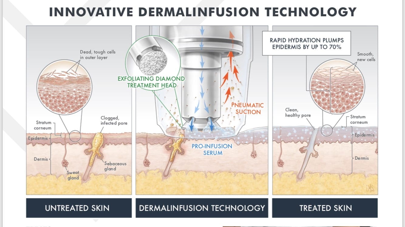 Diamond Glow Microdermabrasion | Radiant, Smooth Skin